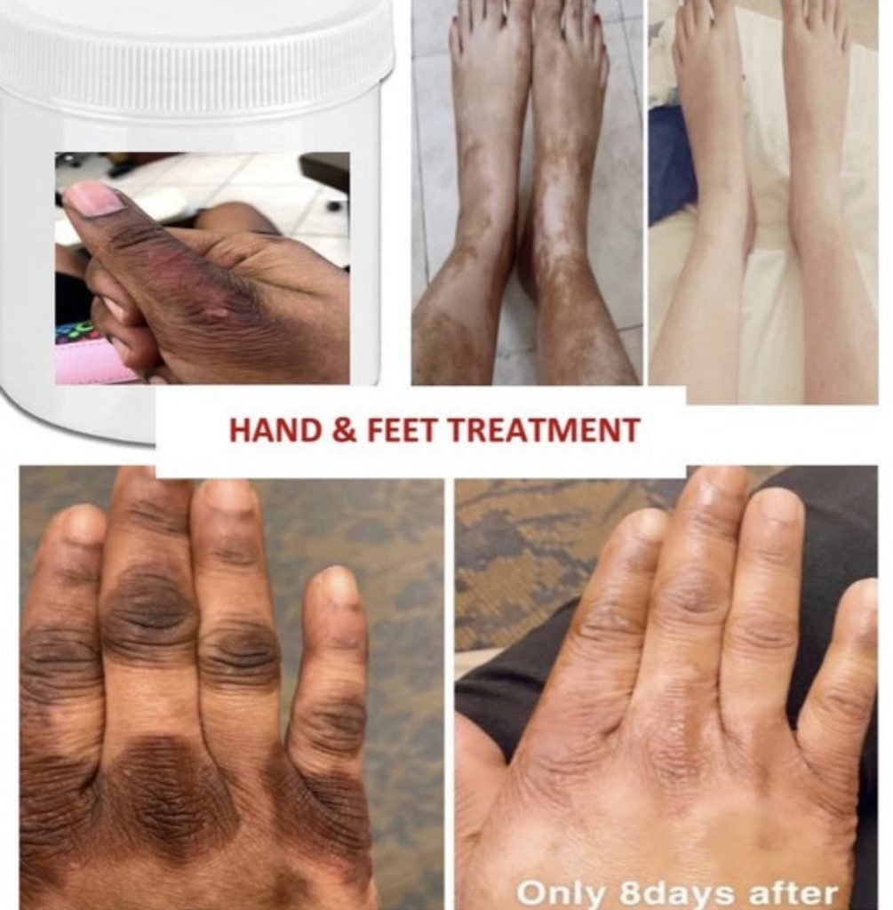 Hand & Feet Treatment Sets ( Chemical Burn Treatment) - Bloommiracle