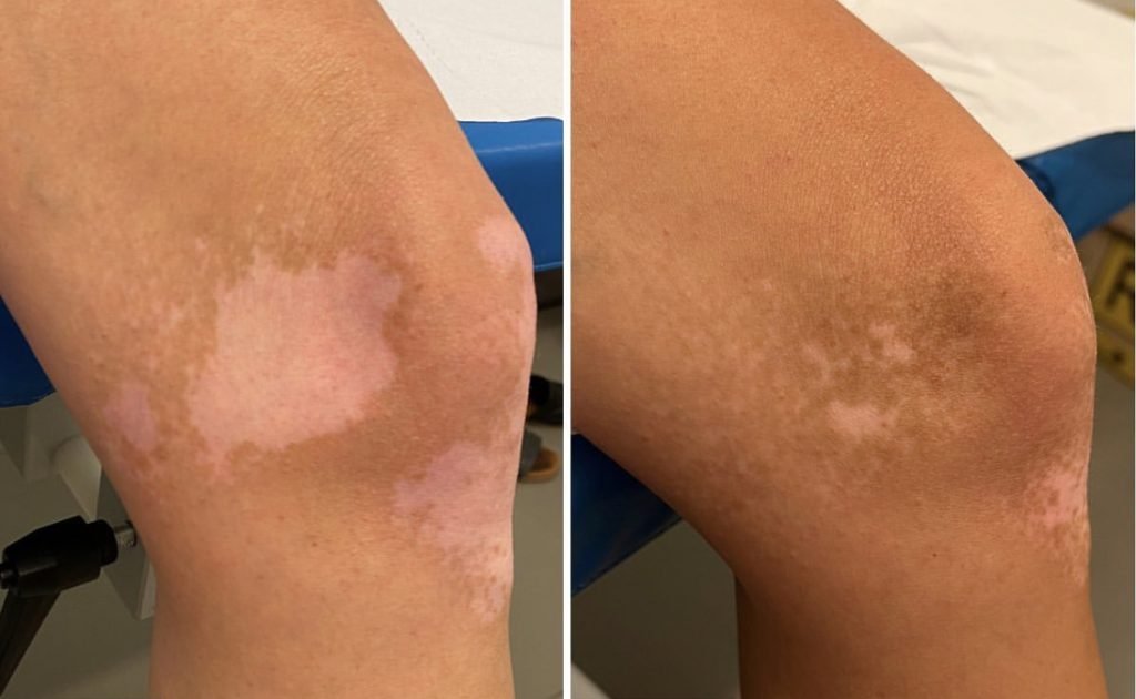 DEPIGMENTED - VITILIGO SKIN Cream - Bloommiracle